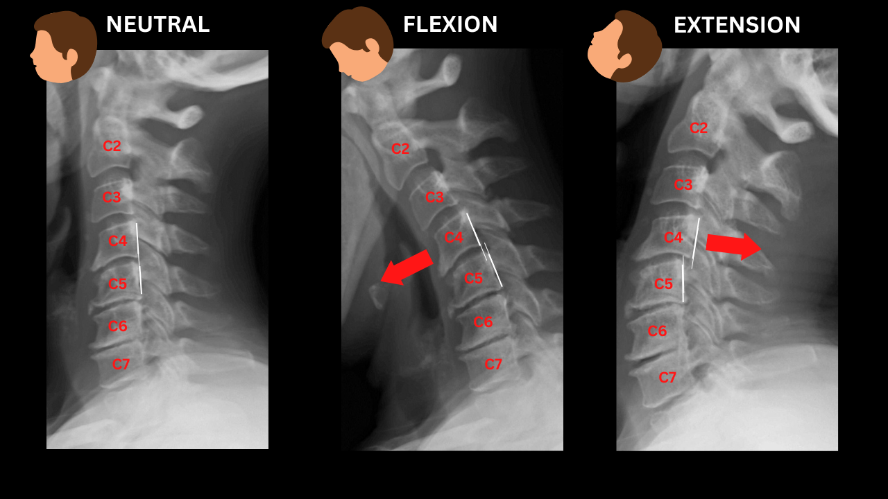 Cervical Instability Chiropractic On Eagle Dr Jon Saunders Cervical Instability Chiropractic On Eagle Dr Jon Saunders