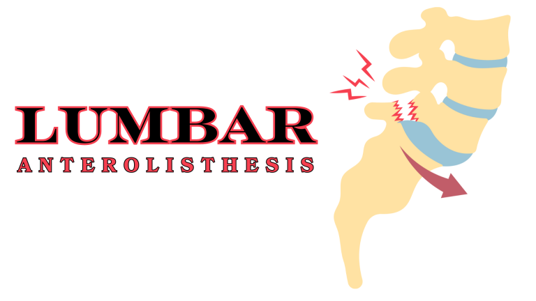 Lumbar Spondylolisthesis: Anterolisthesis - Chiropractic on Eagle, Dr ...